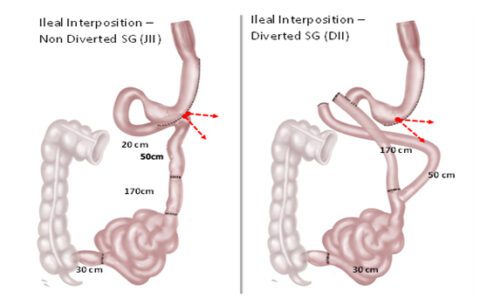 Metabolic Surgery for Diabetes in Delhi – Dr. Saggu