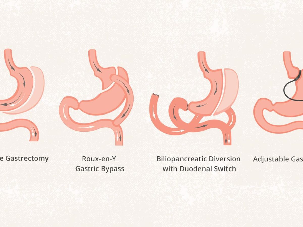 Types Of Gastrectomy Surgery